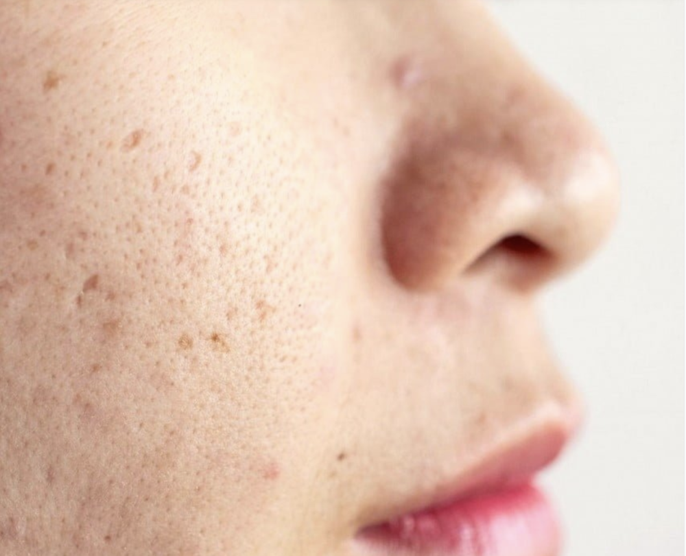 Factors To Consider When Choosing Acne Scar Treatment – DC Fashion Week